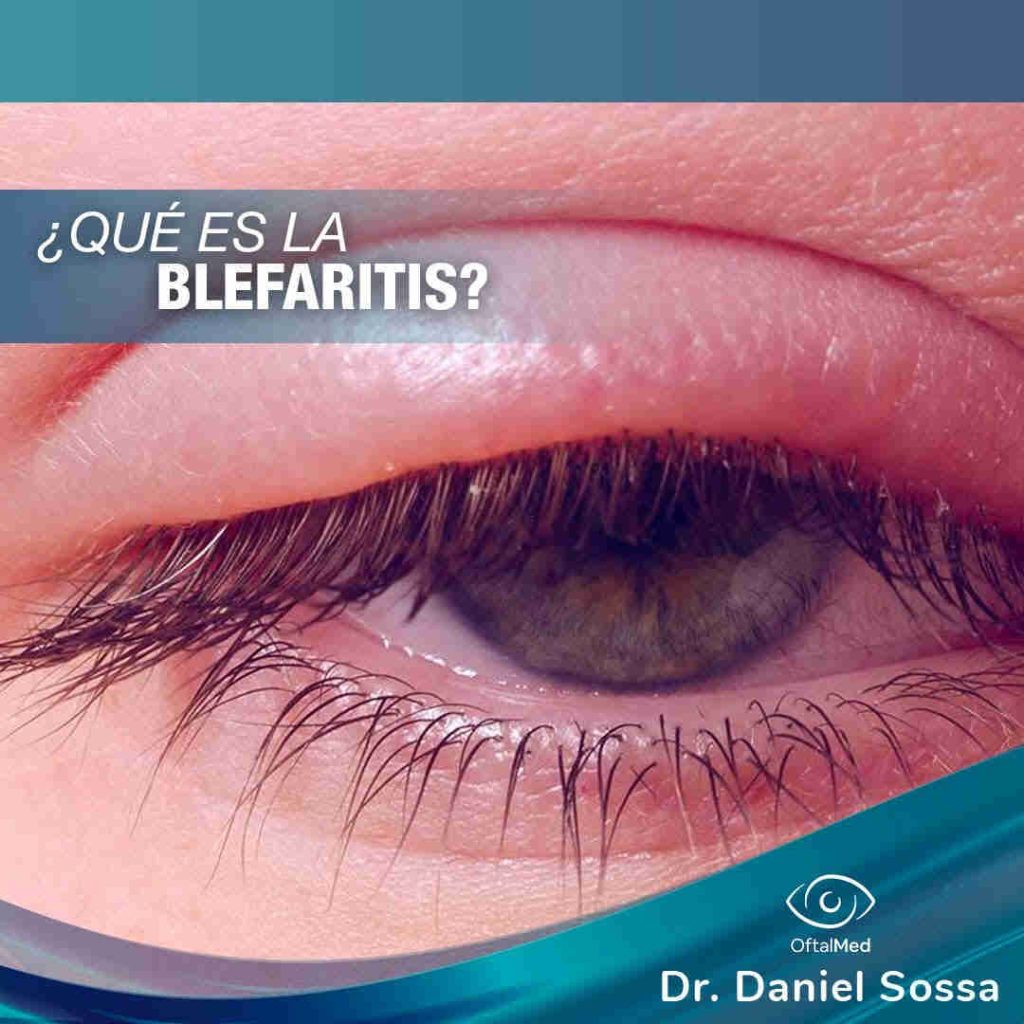 Blefaritis - Dr. Daniel Sossa Mendez - Cirujano Oftalmólogo - Cochabamba
