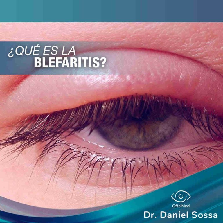 Blefaritis - Dr. Daniel Sossa Mendez - Cirujano Oftalmólogo - Cochabamba