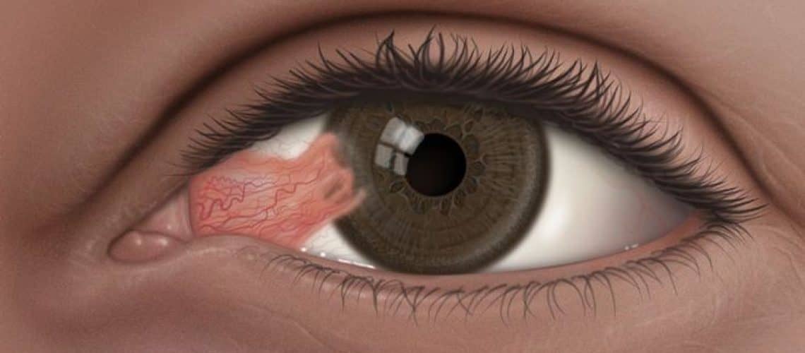 Carnosidad En El Ojo O Pterigion - Dra. Paola Zurita Ferrel ...