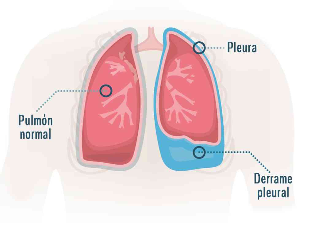 Derrame Pleural - Dr. Edwin E. Marmol Cazas - Cirujano Torácico ...