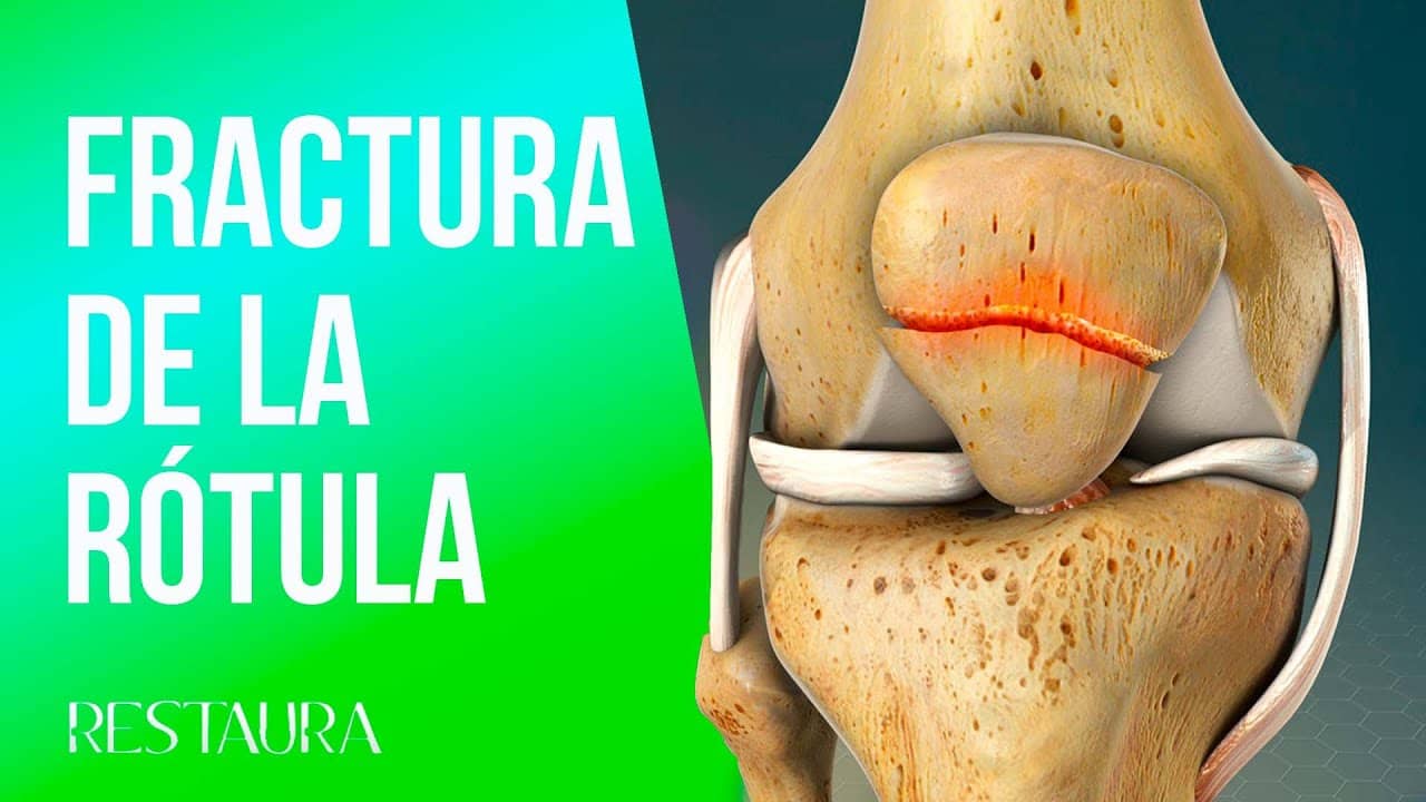 Fractura De Rotula - Dr. Arnold Vergara Montán - Traumatólogo - Cochabamba