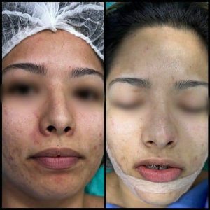 Genioplastia O Mentoplastia Estética - Cirujano Maxilofacial Santa Cruz ...