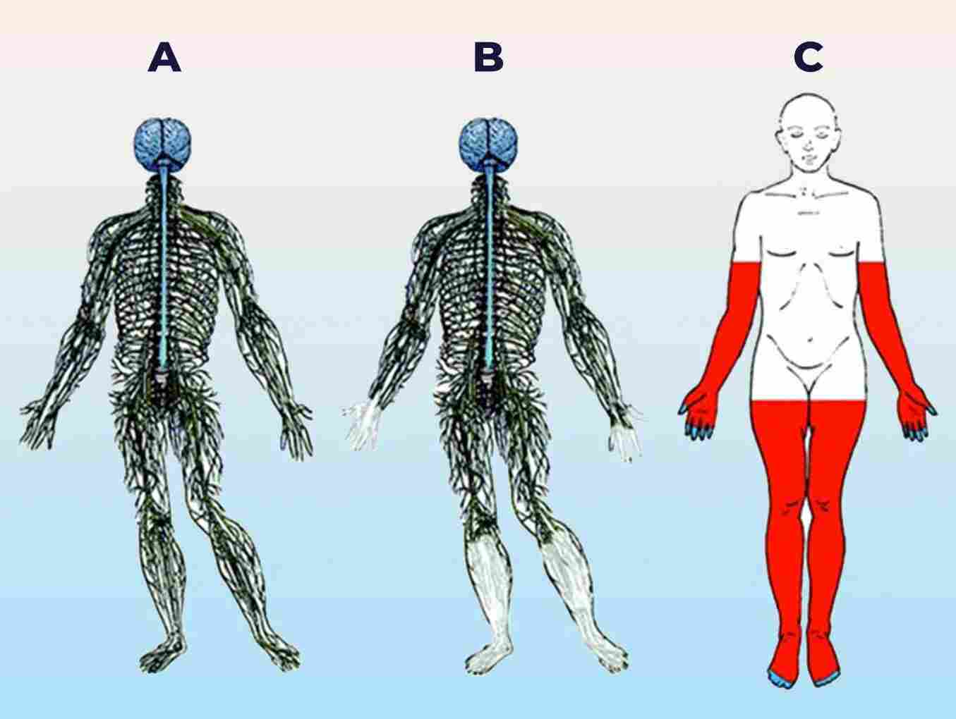 Polineuropatías - Dra. Edna Catherine Serrano Arancibia - Neuróloga ...