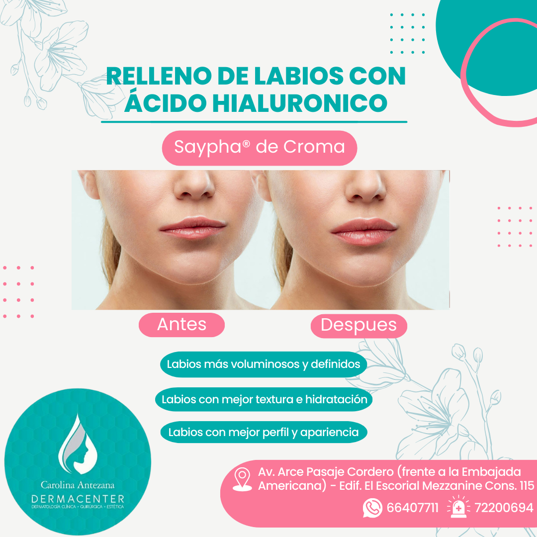 Relleno De Labios Con Acido Hialuronico - Saypha De Croma - Dra ...